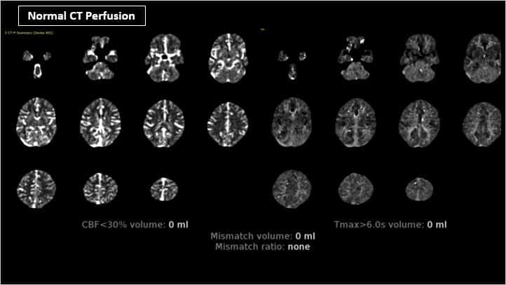 Normal CT Perfusion - World Stroke Academy